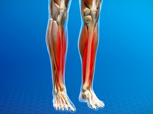 Ortho Blog | Shin Splints (Medial Tibial Stress Syndrome) Video