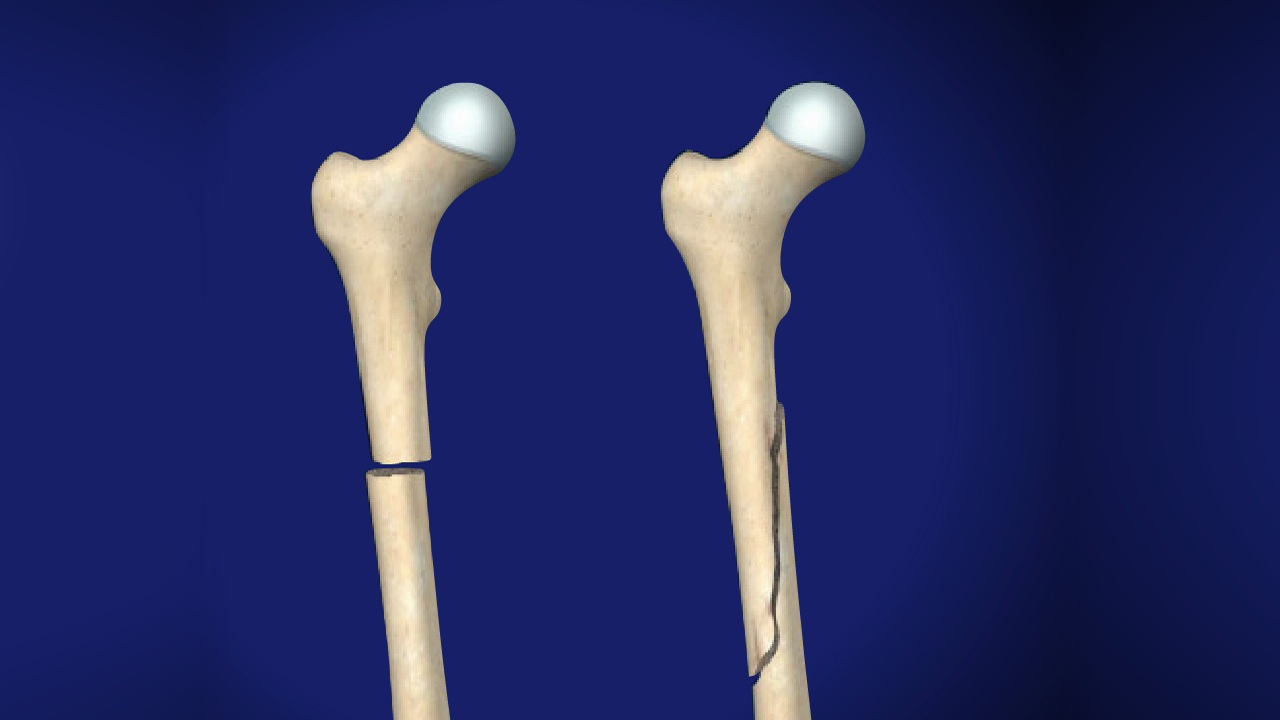 Ortho Blog | Pediatric Femoral Fractures Video