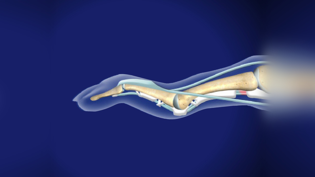 Ortho Blog | Swan Neck Deformity Video