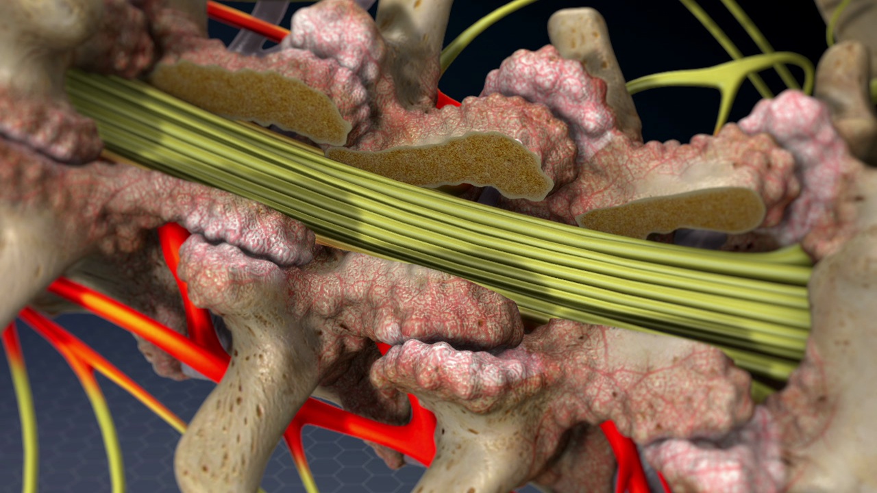 Laminectomy | Spine Conditions | Orthopedic Video Library